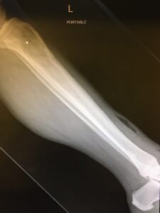 Necrotizing Soft Tissue Injury (NSTI) - Trauma ICU