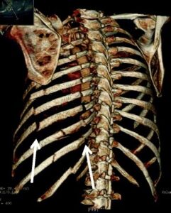 Rib Fracture - Trauma ICU