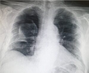 Pneumothorax (PTX) - Trauma ICU