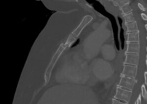 Sternal Fracture - Trauma ICU