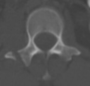 Thoracic/Lumbar Spine Fracture - Trauma ICU