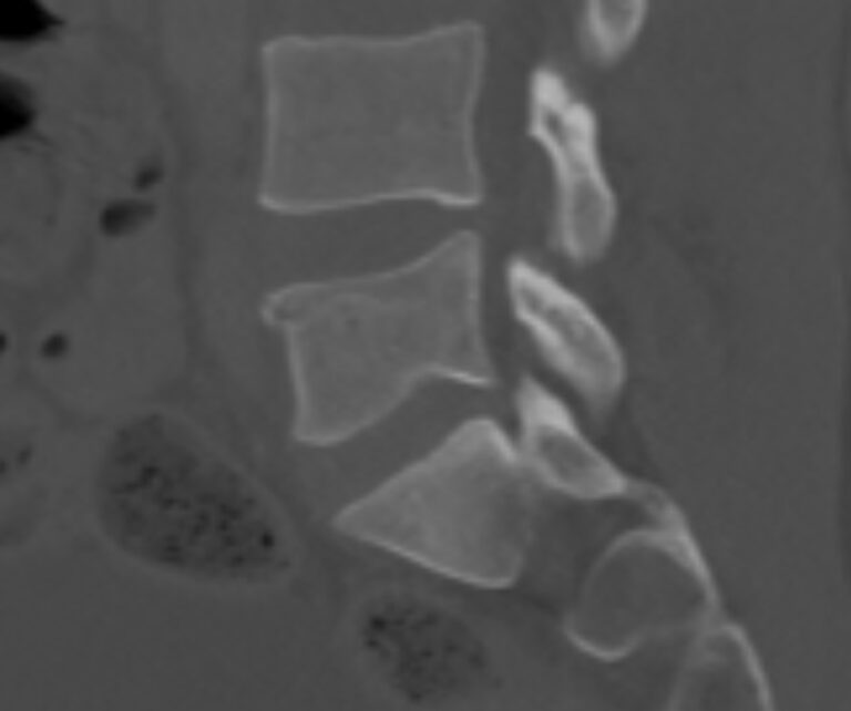 Thoracic/Lumbar Spine Fracture - Trauma ICU