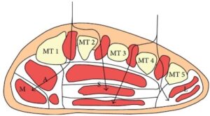 Lower Extremity Fasciotomy - Trauma ICU