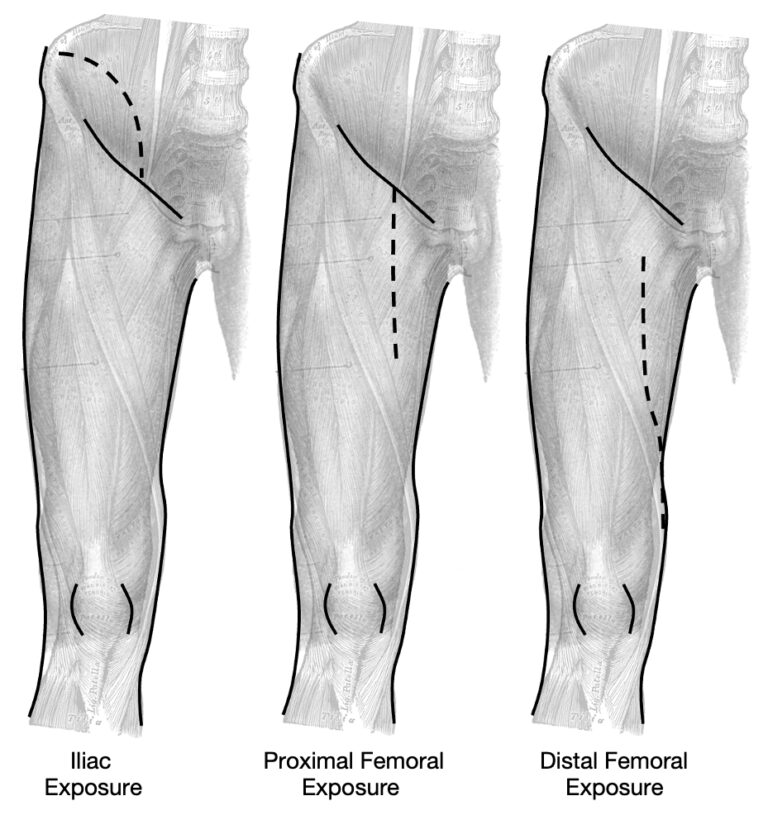 Lower Extremity Vascular Exposure - Trauma ICU