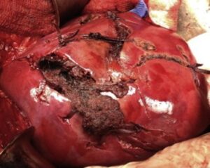 Liver Trauma - Trauma ICU