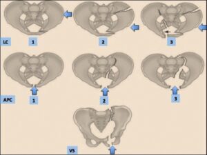 Pelvic Fracture - Trauma ICU