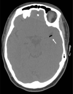 Air Embolism - Trauma ICU